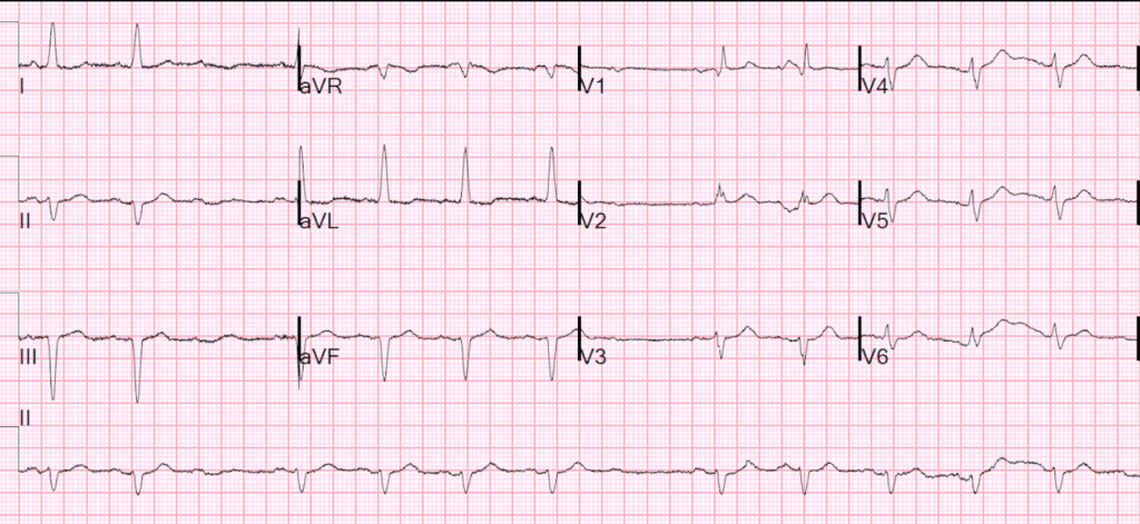 Topic - Second-Degree Atrioventricular Block, Mobitz Type II | 12 Lead ...
