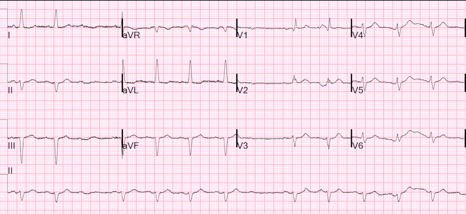 Topic - Second-Degree Atrioventricular Block, Mobitz Type II | 12 Lead ...