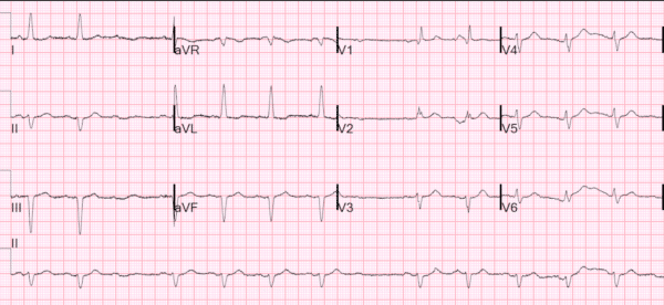 Topic - Second-Degree Atrioventricular Block, Mobitz Type II | 12-Lead ...