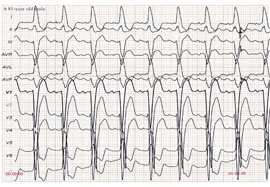 Topic - Incomplete Left Bundle-Branch Block | 12 Lead ECG Course | ACLS ...
