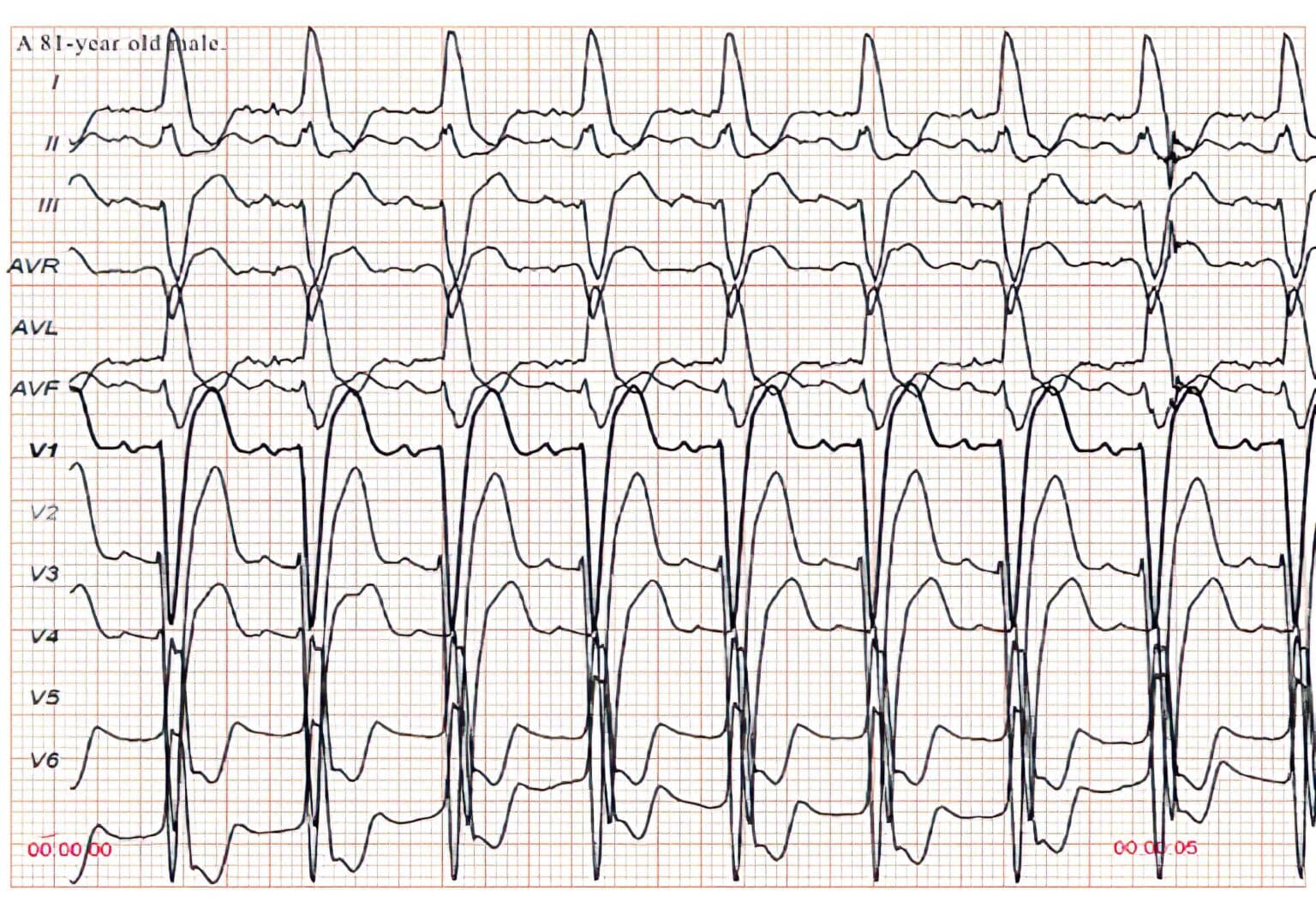 Topic - Incomplete Left Bundle-Branch Block | 12-Lead ECG Certification ...