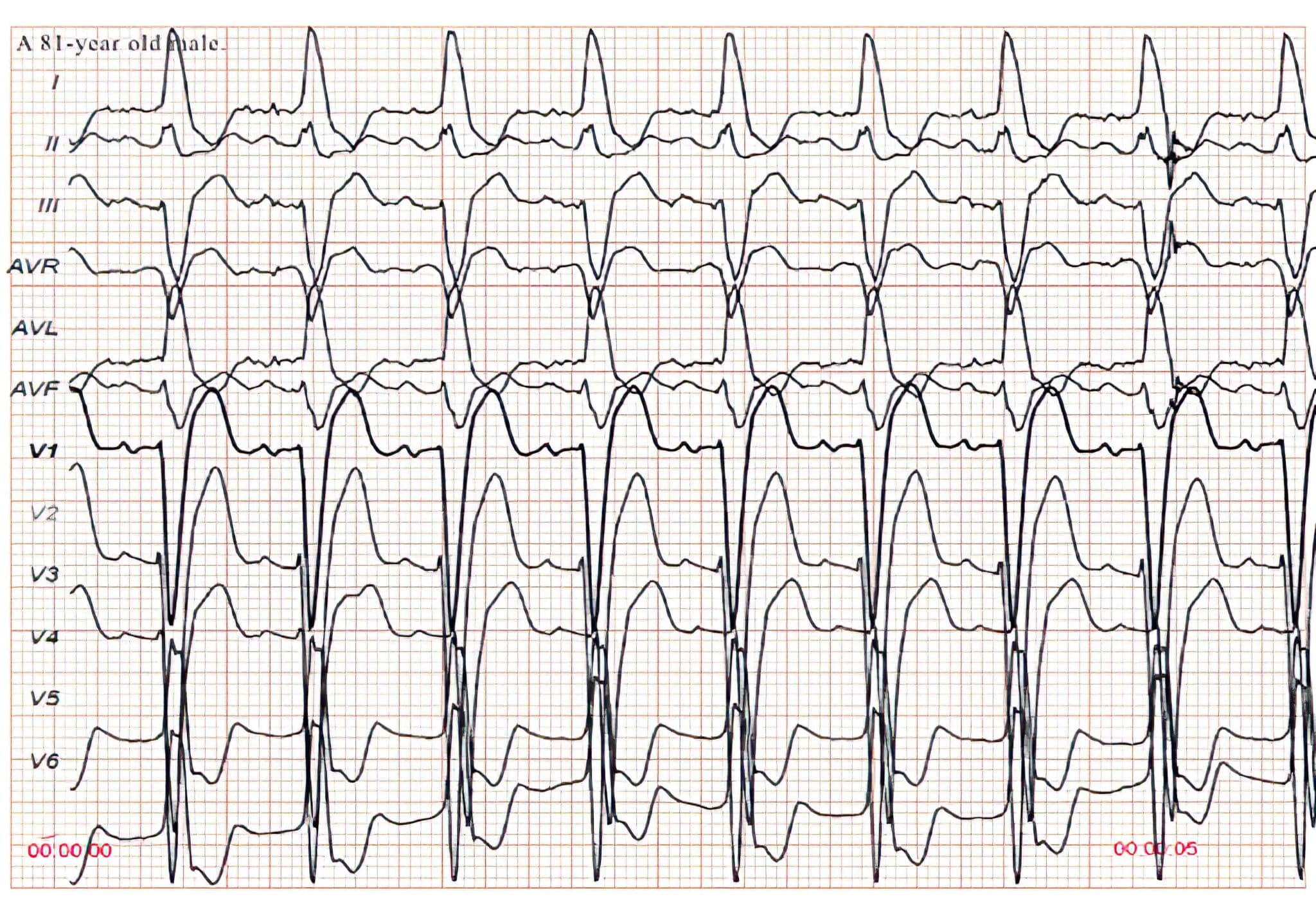 Topic - Incomplete Left Bundle-Branch Block | 12-Lead ECG Certification ...
