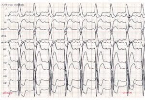 Topic - Incomplete Left Bundle-Branch Block | 12-Lead ECG Certification ...