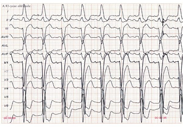 Topic - Incomplete Left Bundle-Branch Block | 12-Lead ECG Certification ...