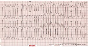 Topic - Tachycardias in Wolff-Parkinson-White Syndrome | 12-Lead ECG ...