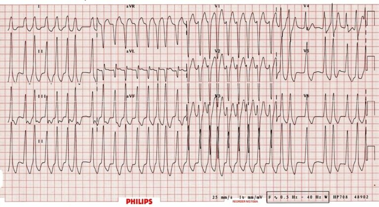Topic - Tachycardias in Wolff-Parkinson-White Syndrome | 12-Lead ECG ...