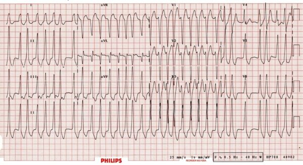 Topic - Atrial Fibrillation | 12 Lead ECG Course | ACLS Certification ...