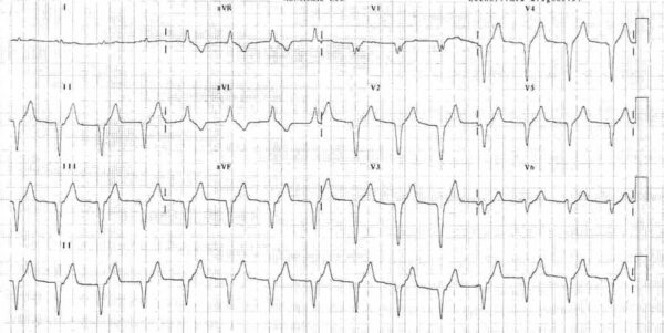 Topic - Types of Ventricular Tachycardia | 12 Lead ECG Course | ACLS ...