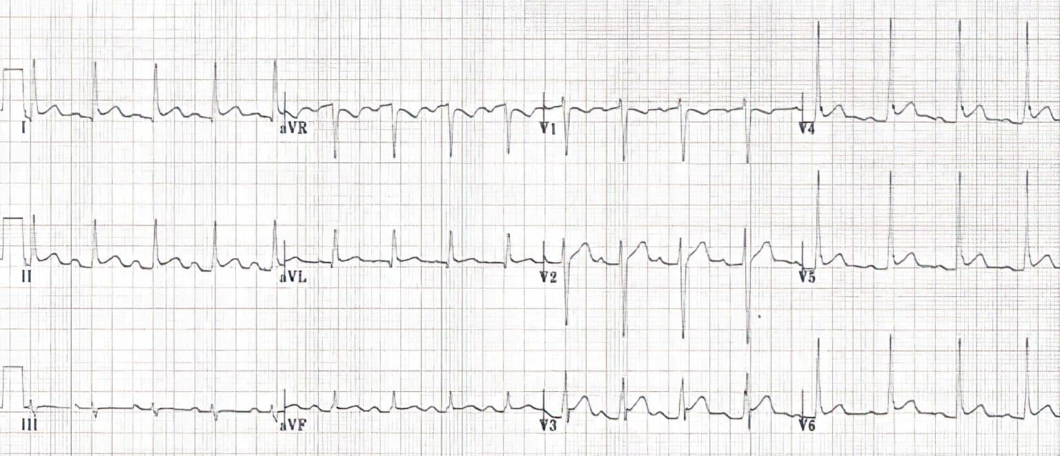 Topic - Acute Pericarditis | 12-Lead ECG Certification Course | ACLS ...