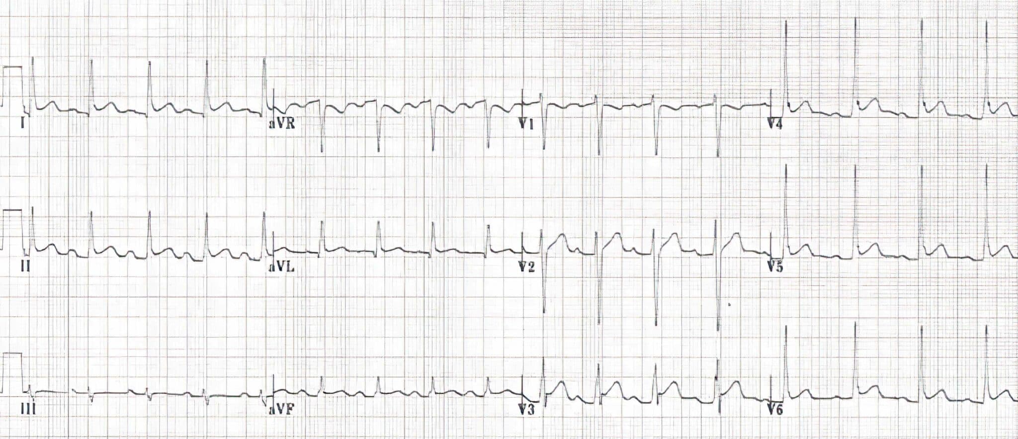 Topic - Acute Pericarditis | 12-Lead ECG Certification Course | ACLS ...