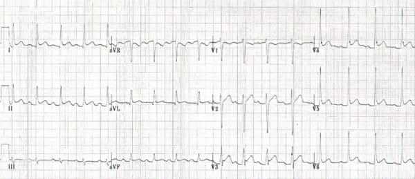 Topic - Acute Pericarditis | 12-Lead ECG Certification Course | ACLS ...
