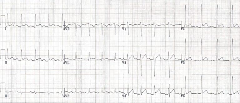 Topic - Acute Pericarditis | 12-Lead ECG Certification Course | ACLS ...
