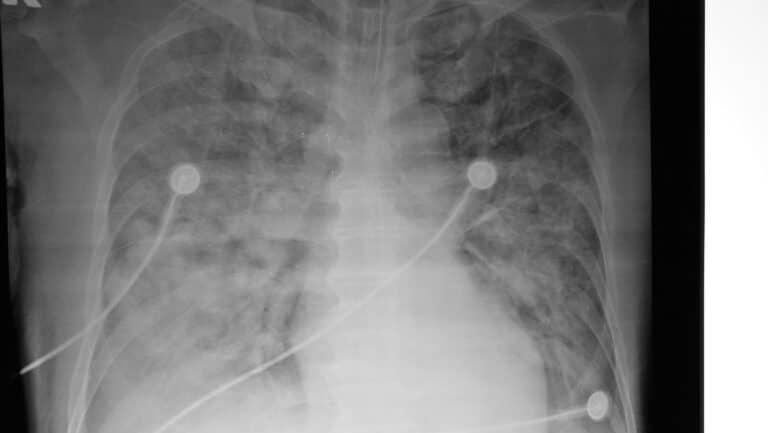Topic - Targeted Management of Respiratory Distress or Failure | PALS ...