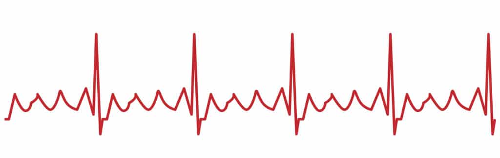 Topic - Atrial Flutter | 12 Lead ECG Course | ACLS Certification ...