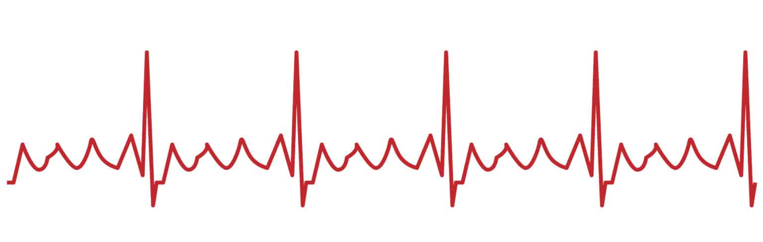 Topic - Atrial Flutter | 12 Lead ECG Course | ACLS Certification ...