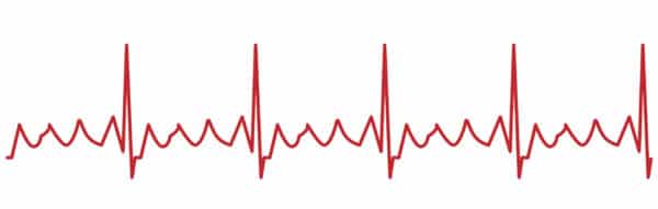 Topic - Atrial Flutter | 12 Lead ECG Course | ACLS Certification ...