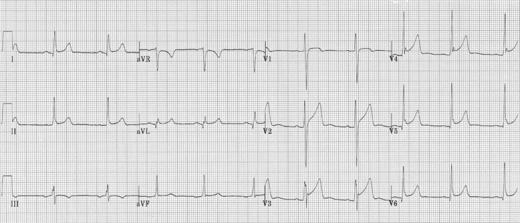 Topic - Acute Pericarditis | 12-Lead ECG Certification Course | ACLS ...
