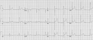 Topic - Acute Pericarditis | 12-Lead ECG Certification Course | ACLS ...