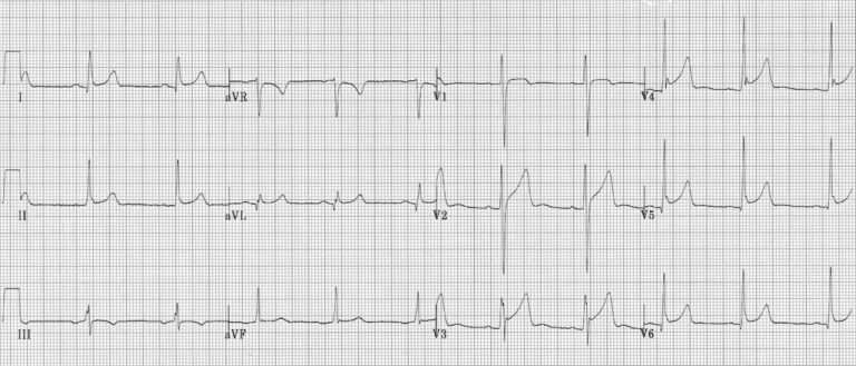 Topic - Acute Pericarditis | 12-Lead ECG Certification Course | ACLS ...