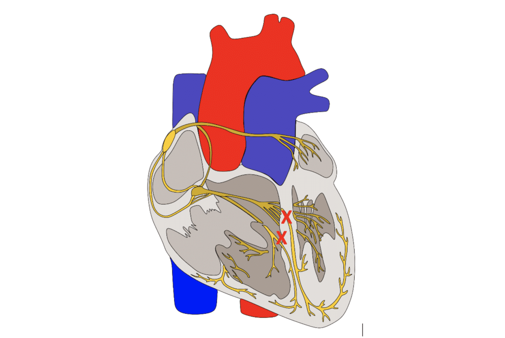 Topic - Right Bundle-Branch Block with Left Anterior Fascicular Block ...