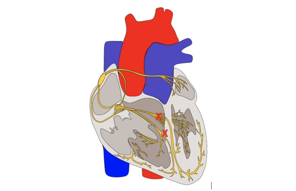 Topic - Right Bundle-Branch Block + Left Posterior Fascicular Block ...