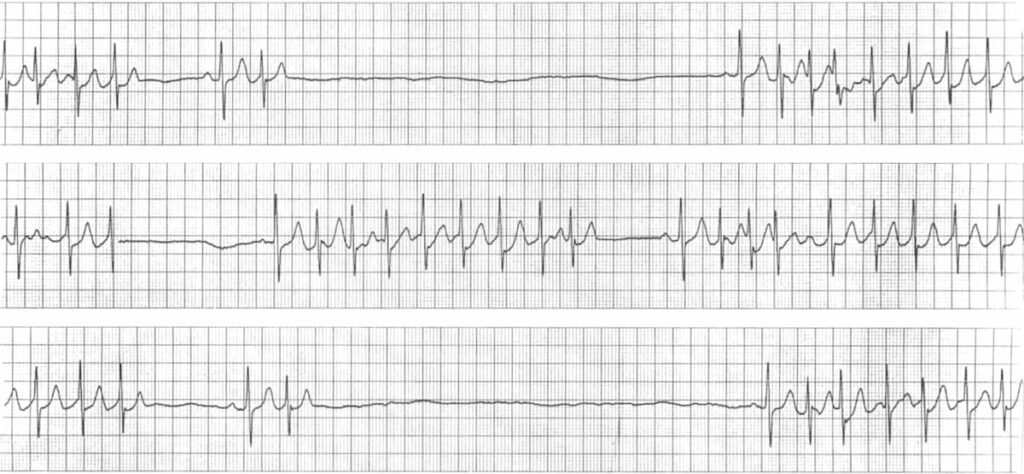 Topic - Electrocardiogram Characteristics of Sinus Node Dysfunction ...