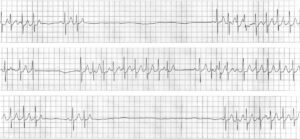 Topic - Electrocardiogram Characteristics of Sinus Node Dysfunction ...
