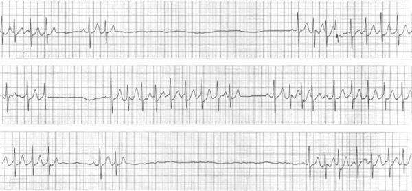 Topic - Electrocardiogram Characteristics of Sinus Node Dysfunction ...