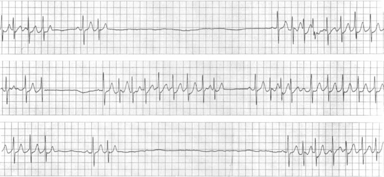 Topic - Electrocardiogram Characteristics of Sinus Node Dysfunction ...