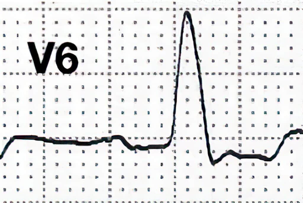 Topic - Rhythm Analysis | 12-Lead ECG Certification Course | ACLS ...