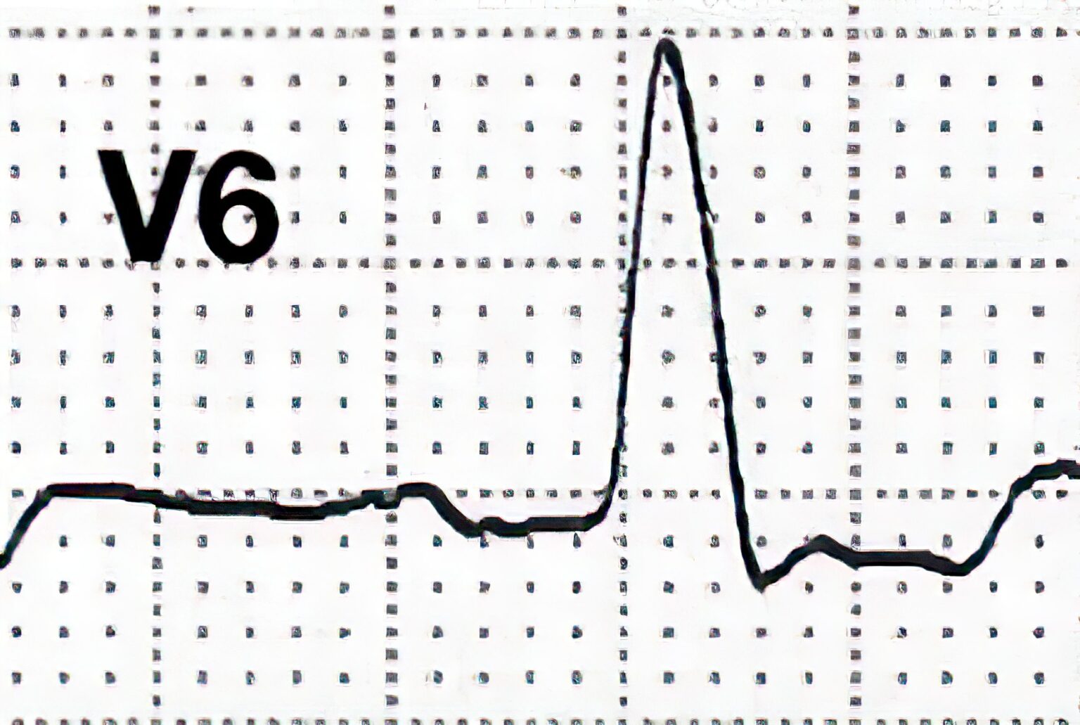 Topic - Rhythm Analysis | 12-Lead ECG Certification Course | ACLS ...