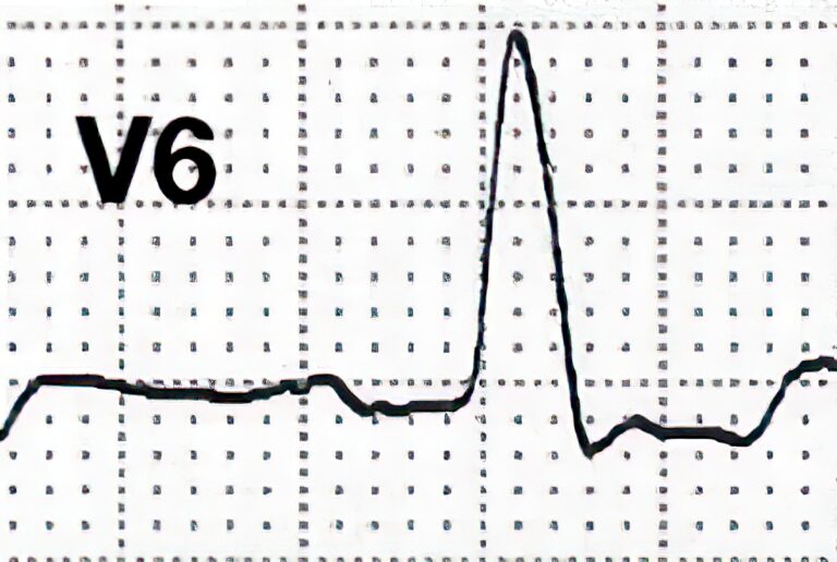 Topic - Rhythm Analysis | 12-Lead ECG Certification Course | ACLS ...