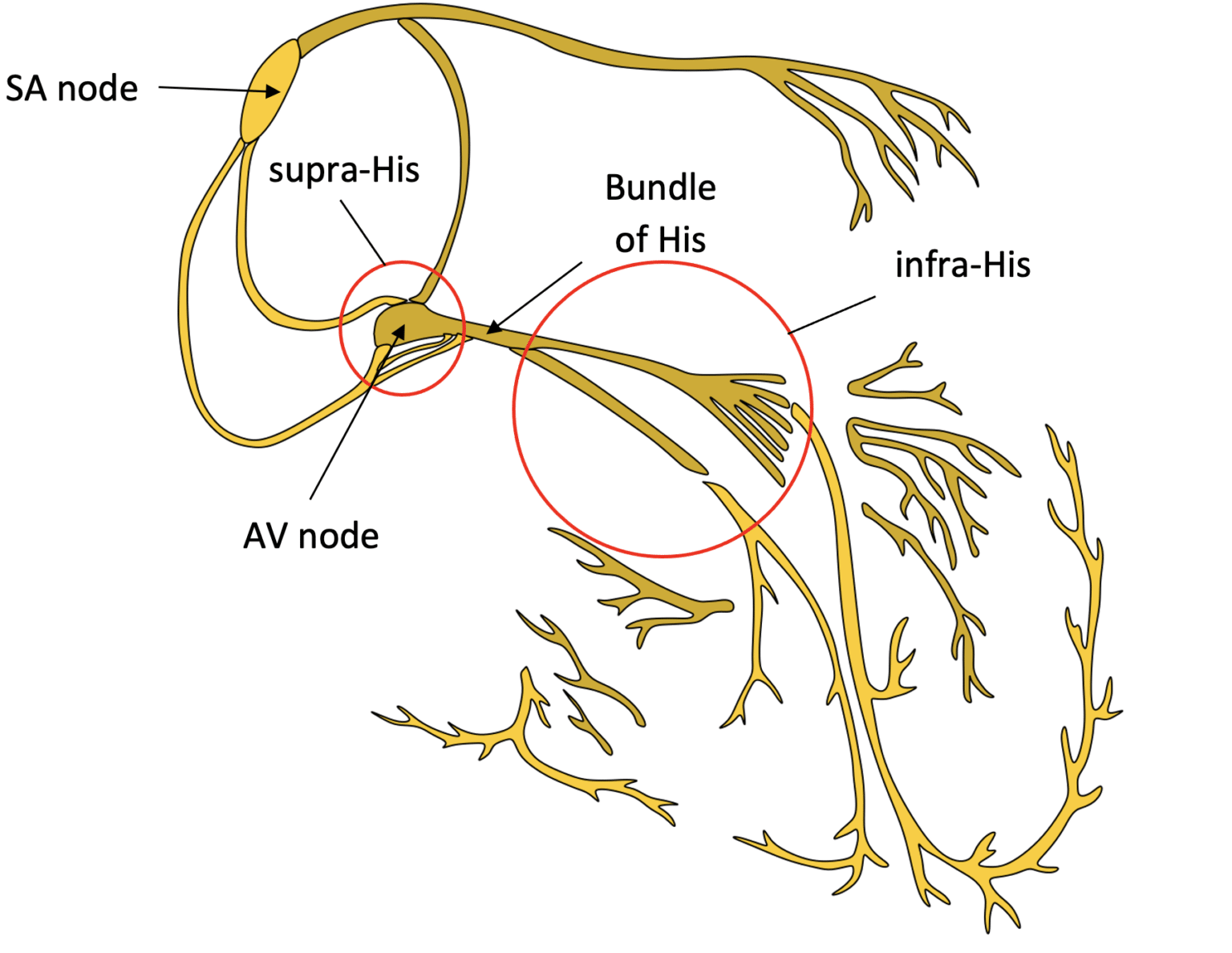 Topic - Third-Degree AV Block, Complete AV Block | 12-Lead ECG ...