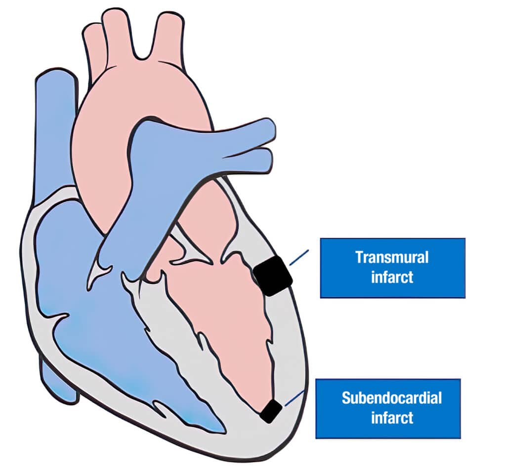 Topic - T and ST Wave Changes in Ischemia | 12-Lead ECG Certification ...
