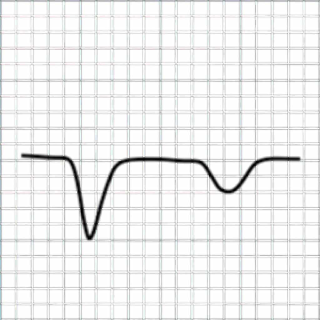 Topic - Electro Pathophysiology | 12-Lead ECG Certification Course ...
