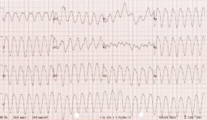 Topic - Types of Ventricular Tachycardia | 12-Lead ECG Certification ...