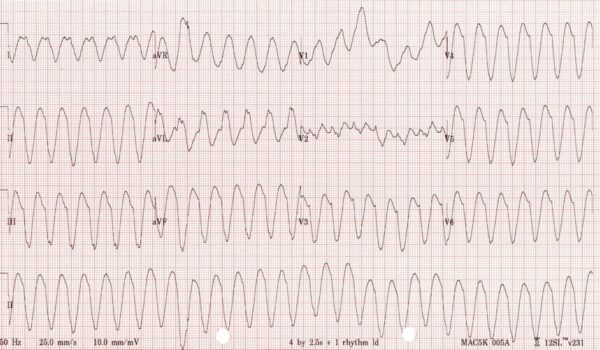 Topic - Types of Ventricular Tachycardia | 12-Lead ECG Certification ...