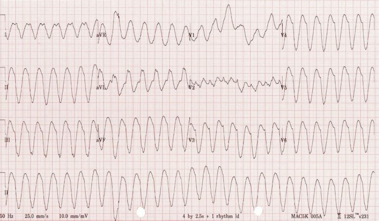 Topic - Types of Ventricular Tachycardia | 12-Lead ECG Certification ...