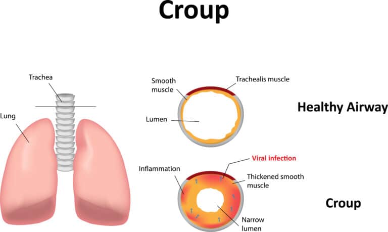 Topic - Targeted Management of Respiratory Distress or Failure | PALS ...