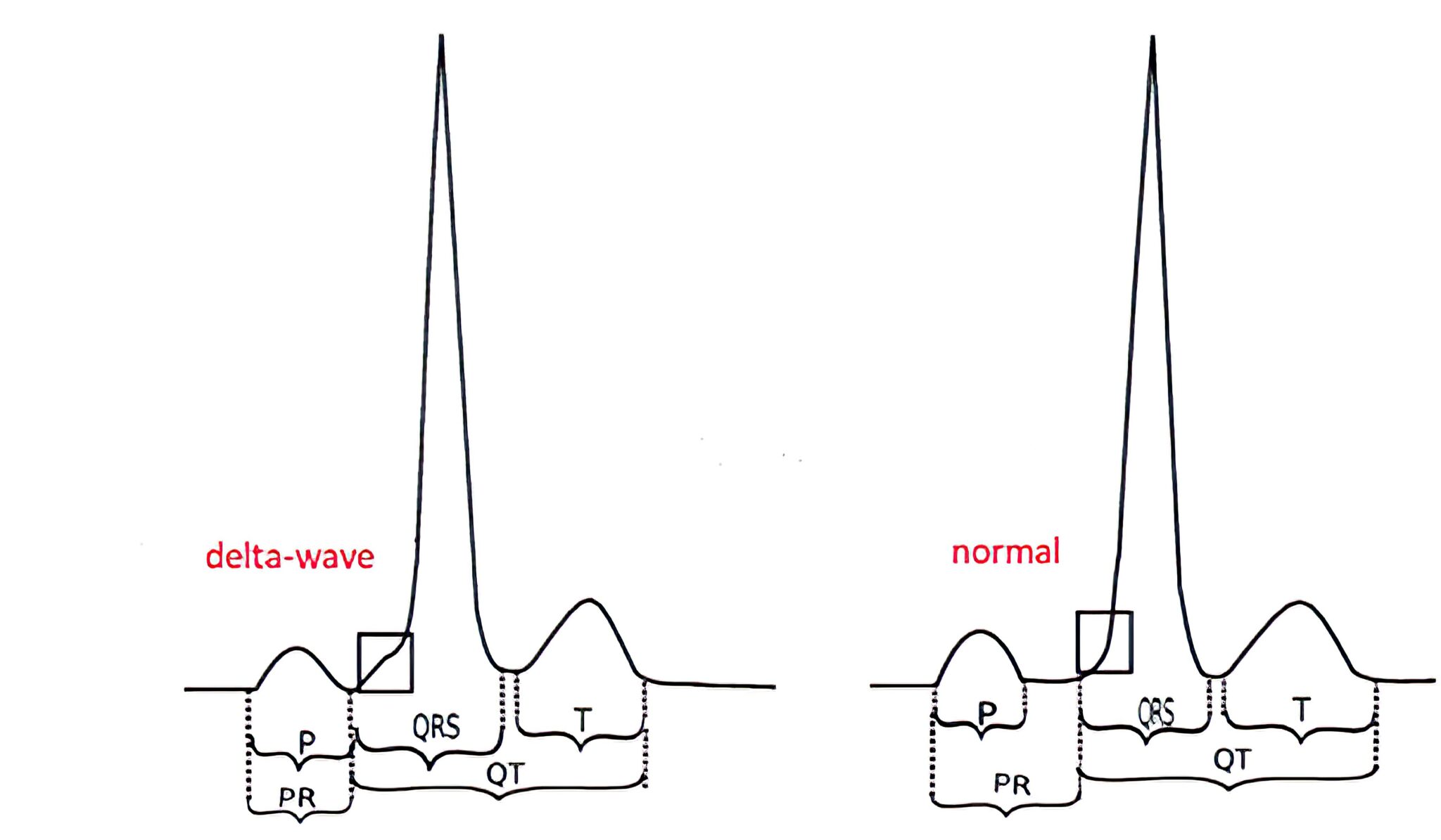 Topic - The QRS Complex | 12-Lead ECG Certification Course | ACLS ...