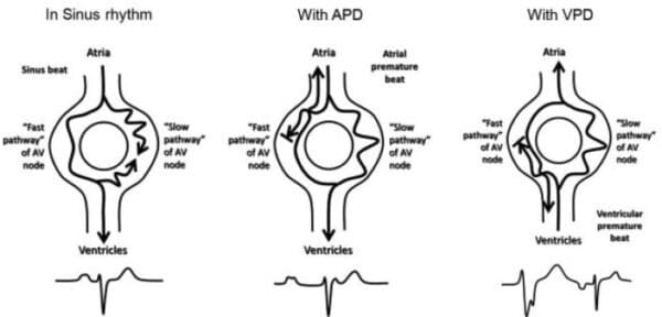 Topic - Conduction in Sinus Rhythm | 12 Lead ECG Course | ACLS ...