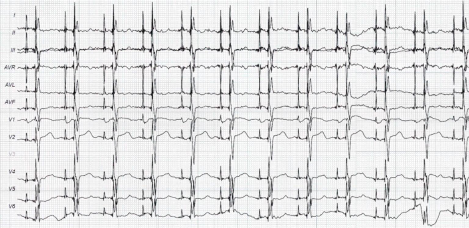 Topic - Double-Chamber Pacemaker | 12-Lead ECG Certification Course ...