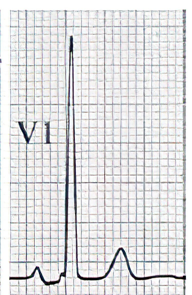 Topic - Electrocardiographic Findings | 12 Lead ECG Course | ACLS ...