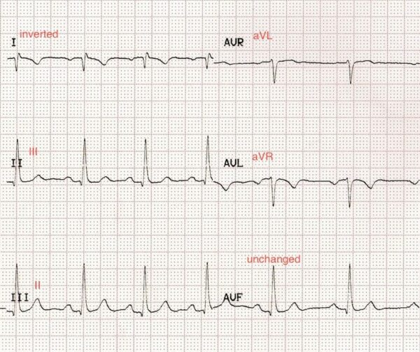 Topic - Other Causes of Q Waves | 12-Lead ECG Certification Course ...