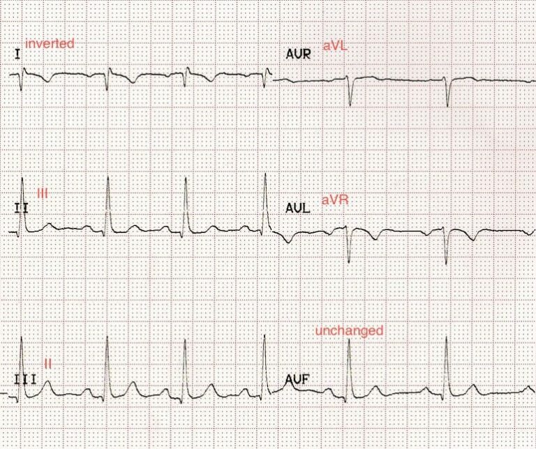 Topic - Other Causes of Q Waves | 12-Lead ECG Certification Course ...