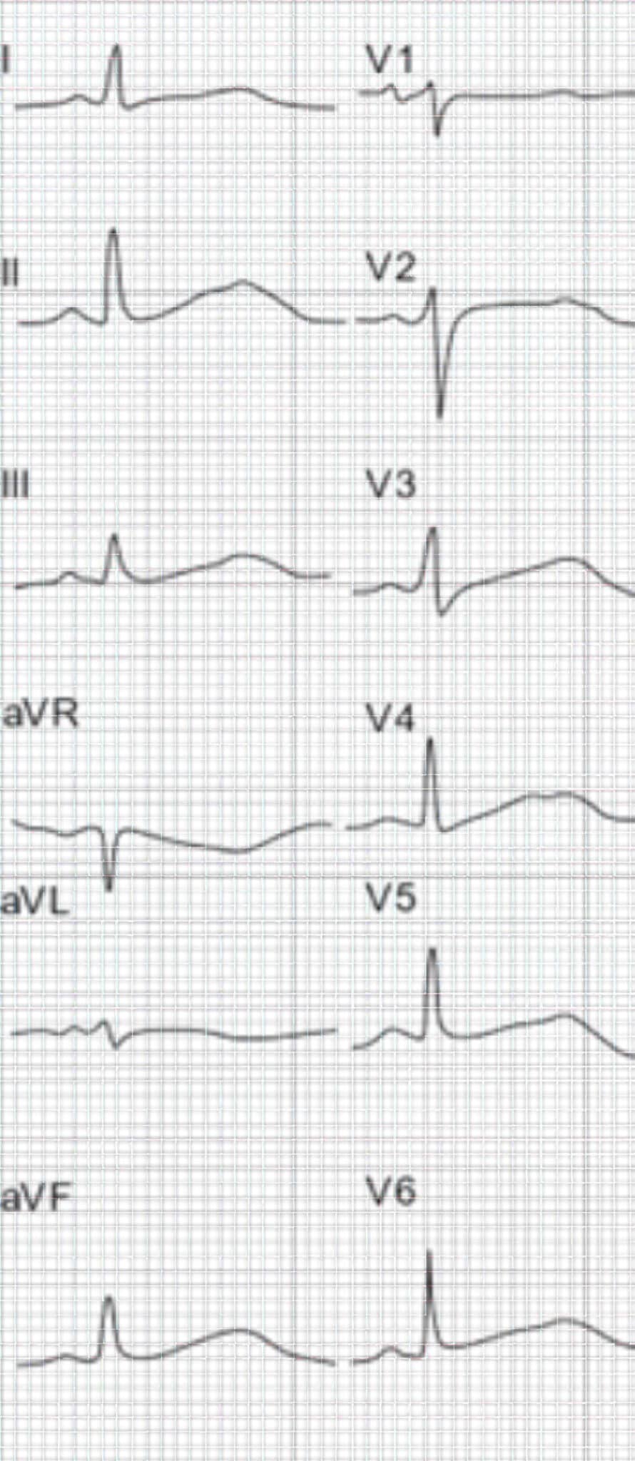 Topic - Hypokalemia | 12-Lead ECG Certification Course | ACLS ...