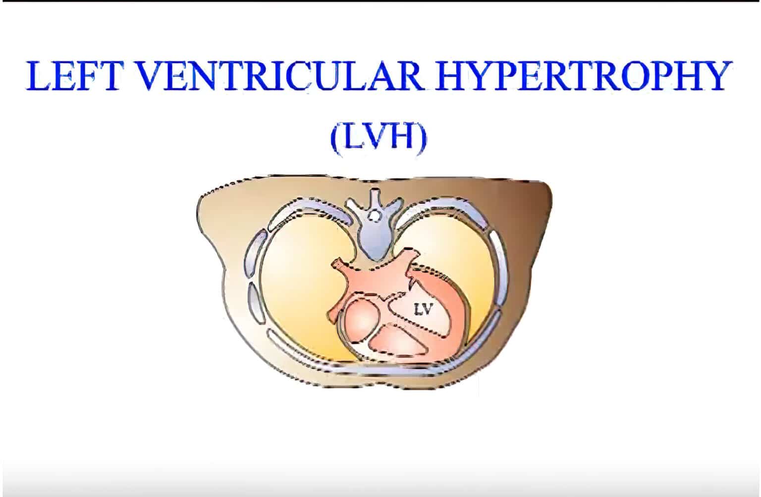 Topic - Electrocardiographic Criteria for Diagnosing Left Ventricular ...