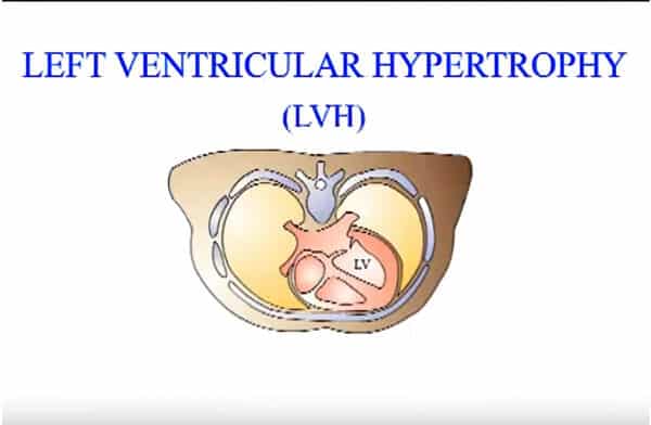 Topic - Electrocardiographic Criteria for Diagnosing Left Ventricular ...