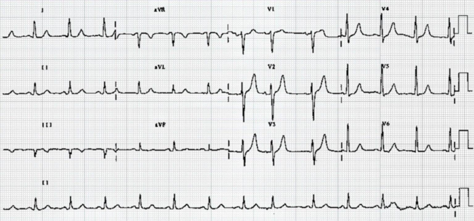 Topic - Premature Atrial Contractions in the Inferior Aspect of the ...