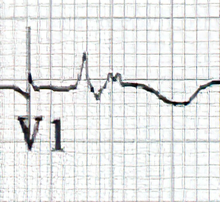 Topic - Electrocardiographic Findings | 12-Lead ECG Certification ...